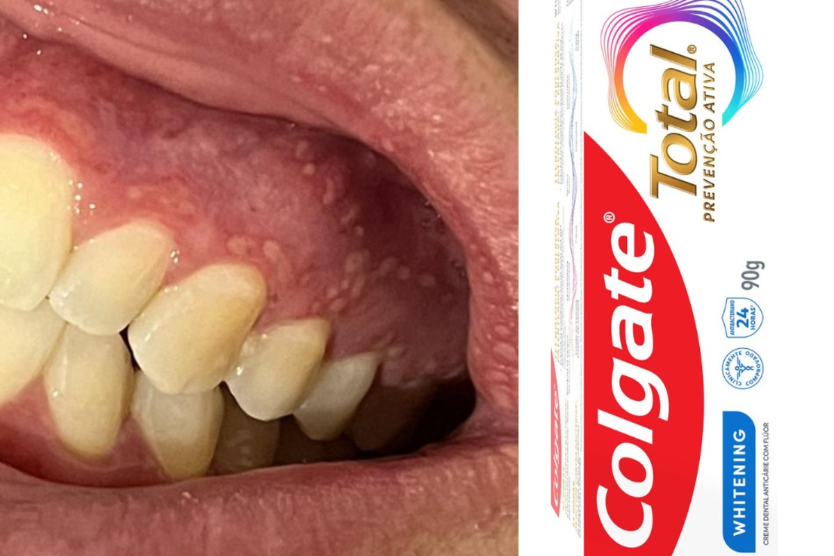 Anvisa interdita linha de cremes dentais da Colgate após lesões bucais em consumidores